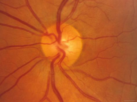 Normal Optic Disc Assessing And Diagnosing The Paediatric Optic Disc