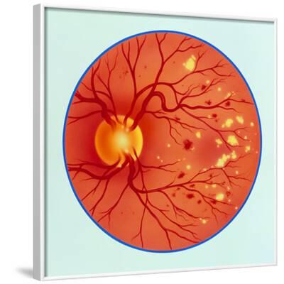 'Artwork of Diabetic Retinopathy Ophthalmoscope View' Photographic ...