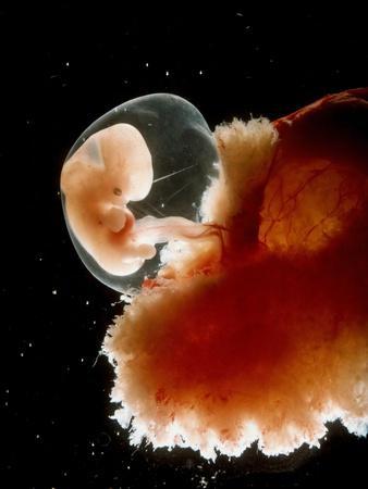 'Biology and Pregnancy: Amniotic Pocket Containing a Human Embryo (Then ...
