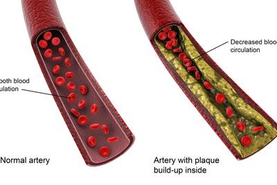 'Comparison of a healthy artery and an unhealthy artery with plaque ...