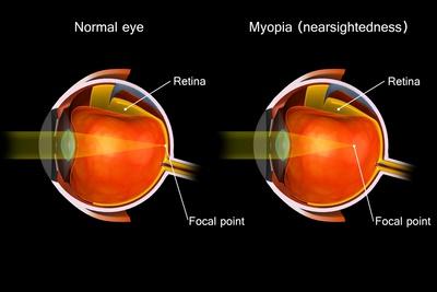 'Comparison of a normal eye and an eye with myopia.' Art - Stocktrek ...