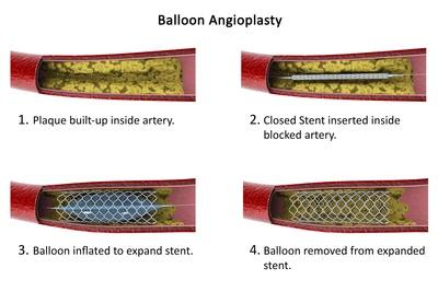 'Diagram showing procedure of balloon angioplasty.' Prints - Stocktrek ...