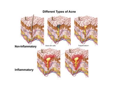 'Different Types of Acne, Non-Inflammatory and Inflammatory' Posters ...