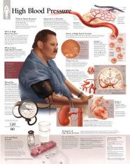 Laminated High Blood Pressure Educational Chart Poster Print Laminated High Blood Pressure Educational Chart Poster Print