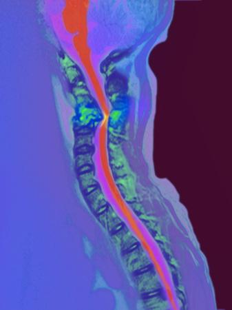 'Inflamed Spinal Discs, MRI Scan' Photographic Print - Du Cane Medical ...