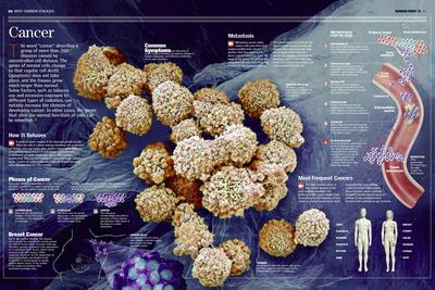 'Infographic of Cancerous Tissue, Metastasis, and the Most Common Types ...