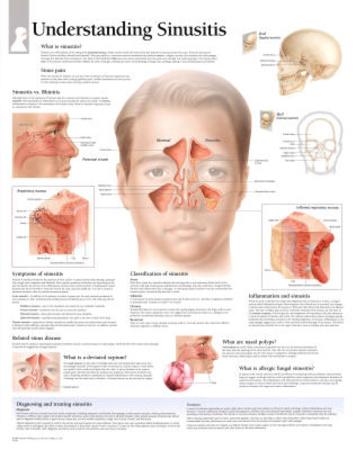 'Laminated Understanding Sinusitis Educational Chart Poster' Prints ...