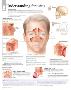 'Laminated Understanding Sinusitis Educational Chart Poster' Prints ...
