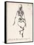 'Skeleton of an Adult Patient Afflicted with Rickets' Giclee Print ...