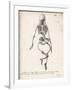 'Skeleton of an Adult Patient Afflicted with Rickets' Giclee Print ...
