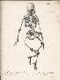 'Skeleton of an Adult Patient Afflicted with Rickets' Giclee Print ...