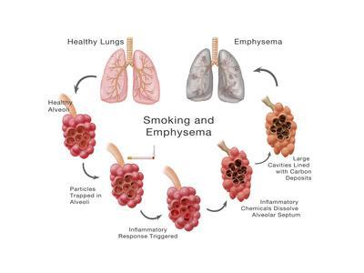 'Lung Damage Leading to Emphysema' Posters - Monica Schroeder ...