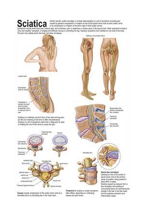 'Medical Chart Showing the Signs and Symptoms of Sciatica' Prints ...