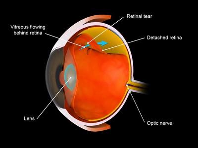 'Medical illustration of a detached retina.' Poster - Stocktrek Images ...