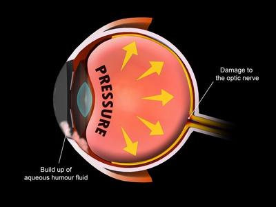 'Medical illustration showing increased pressure in the eyeball ...