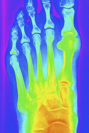 'Normal Left Foot, X-ray' Photographic Print - PASIEKA | AllPosters.com