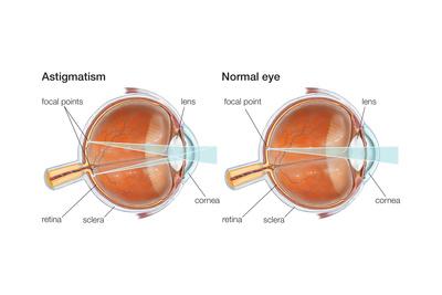 'Scleral Buckle. Eye, Ophthalmology, Health and Disease' Prints ...