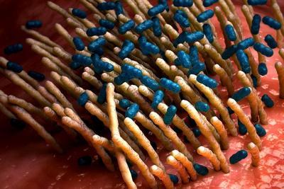 'Biomedical illustration of the bacterial disease pertussis, also known ...