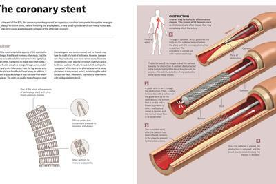 The coronary stent. Photographic Print | AllPosters.com