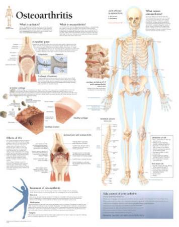 'Understanding Osteoarthritis Educational Chart Poster' Posters ...