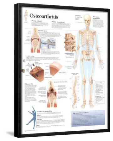 'Understanding Osteoarthritis Educational Chart Poster' Posters ...