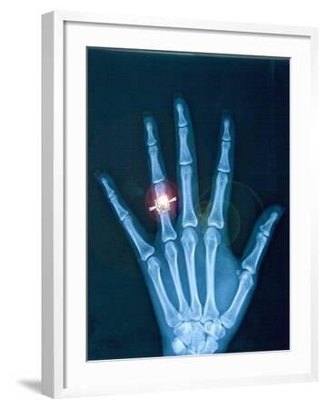 'X-ray of hand with diamond ring' Photographic Print - Thom Lang ...