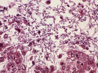 Candida Yeast Infection