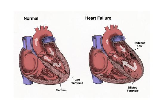 Healthy Heart vs. Heart Failure Print by Spencer Sutton at AllPosters.com
